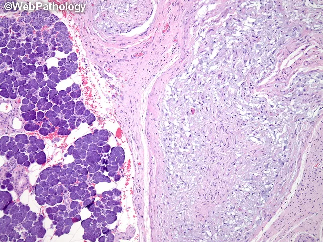 Plexiform Neurofibroma
