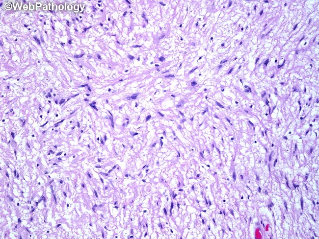 Plexiform Neurofibroma