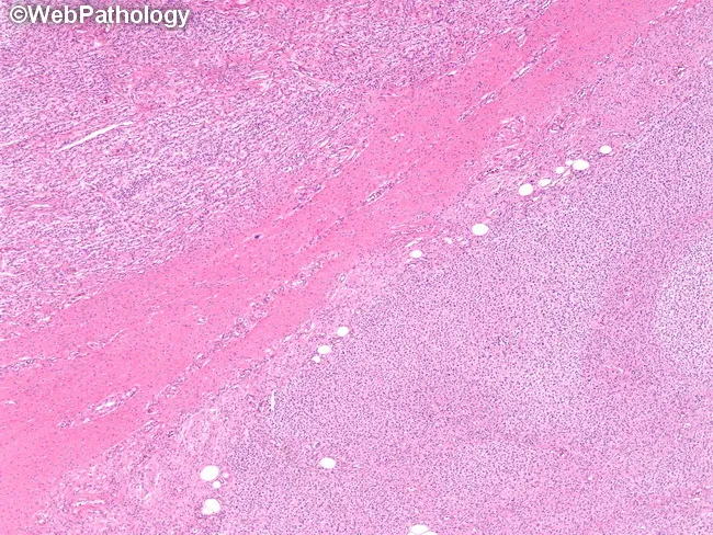 Diffuse Neurofibroma