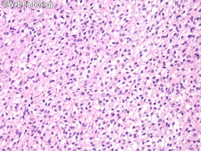 Diffuse Neurofibroma
