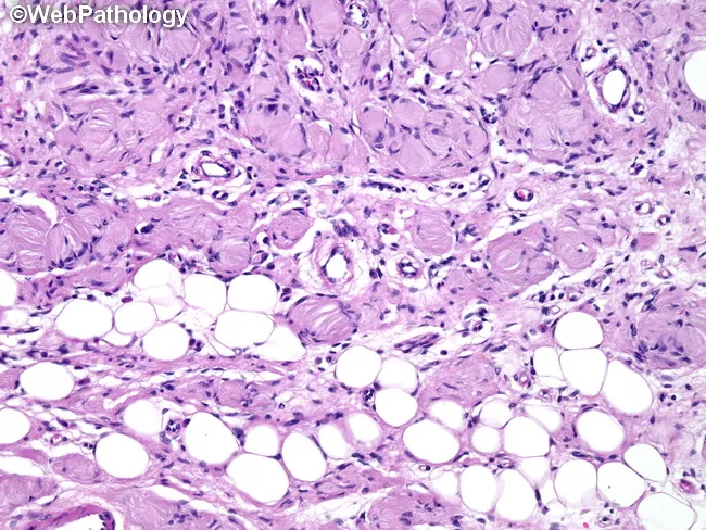 Diffuse Neurofibroma