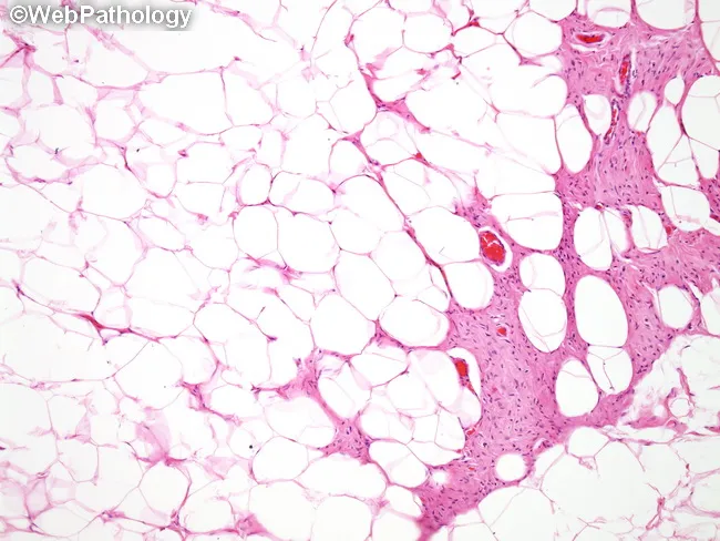 Diffuse Neurofibroma