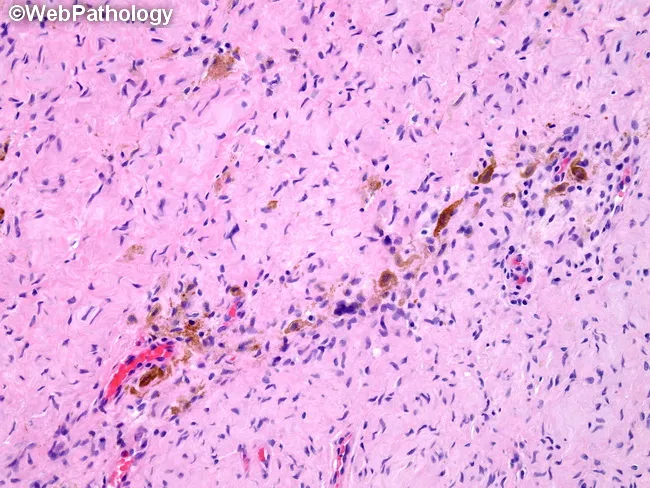 Pigmented Neurofibroma