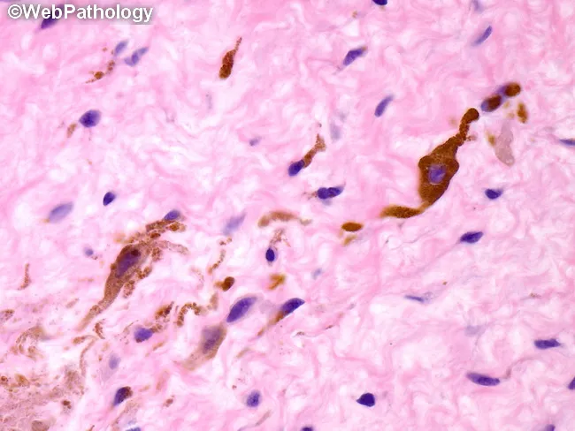 Pigmented Neurofibroma