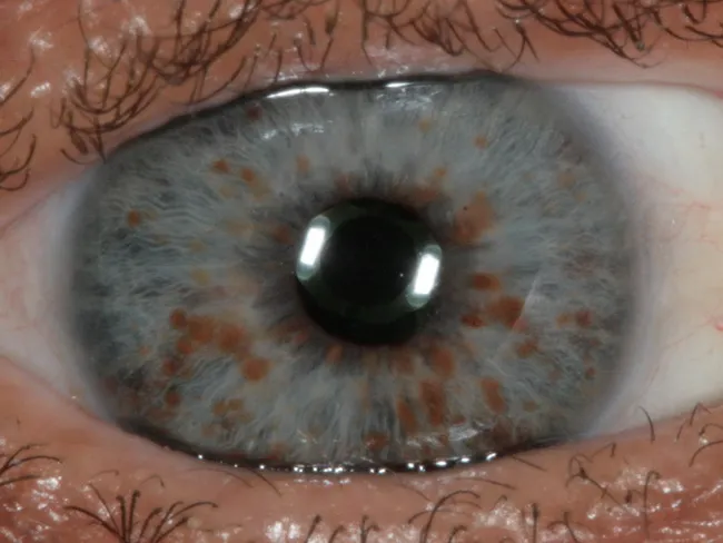 Neurofibromatosis 1 : Lisch Nodules