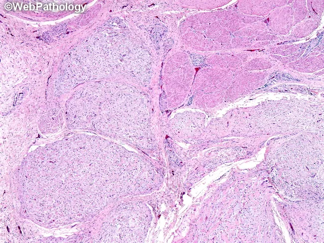 Neurofibromatosis 1 : Plexiform Neurofibromas