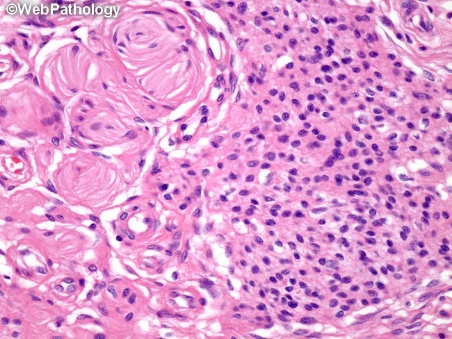 Neurofibromatosis 1 : Diffuse Neurofibroma