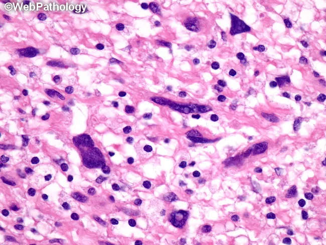 NF1 : Neurofibroma with Atypical Features