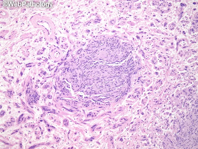 Schwannoma : Antoni A & B
