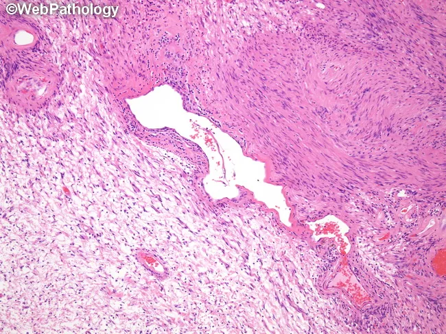 Schwannoma : Antoni A & B