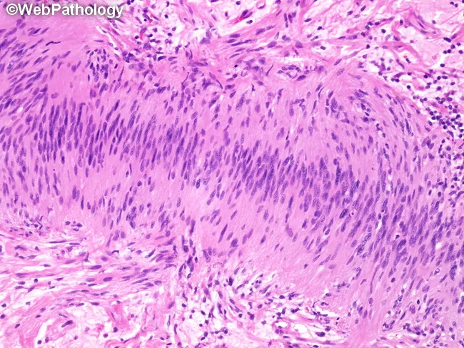 Schwannoma : Verocay Bodies