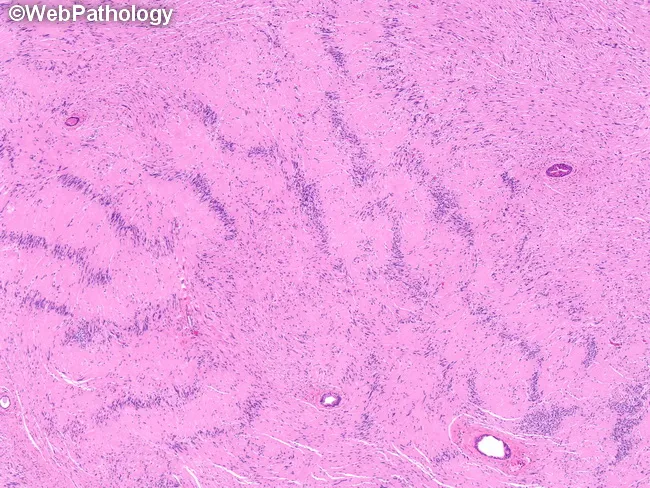 Schwannoma : Verocay Bodies