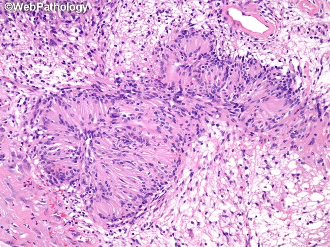 Schwannoma : Verocay Bodies