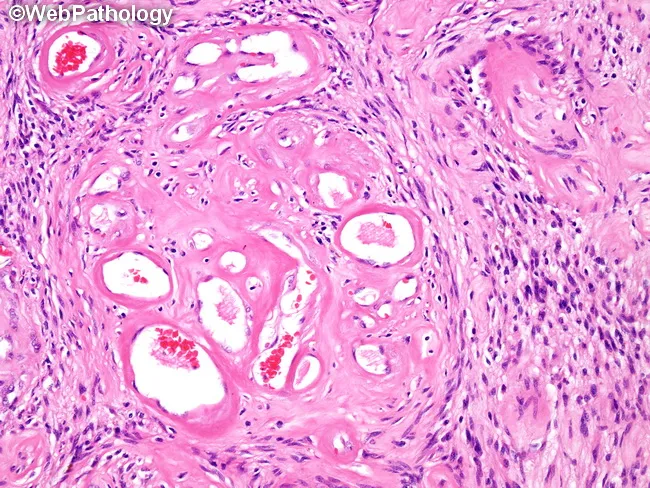 Schwannoma : Hyalinized Vessels