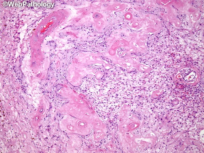 Schwannoma : Hyalinized Vessels
