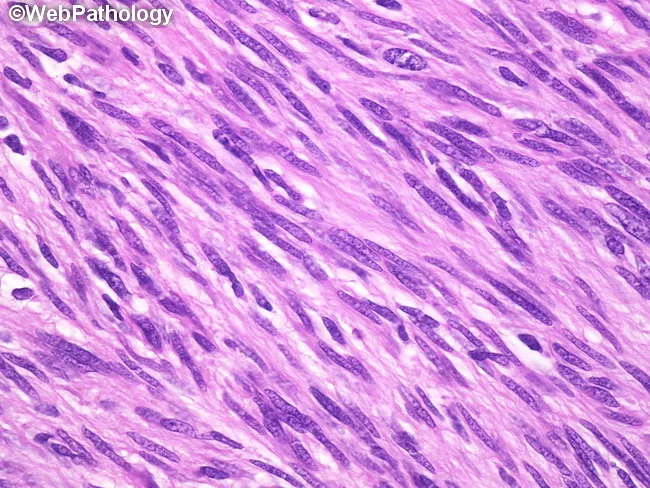 schwannoma histology findings
