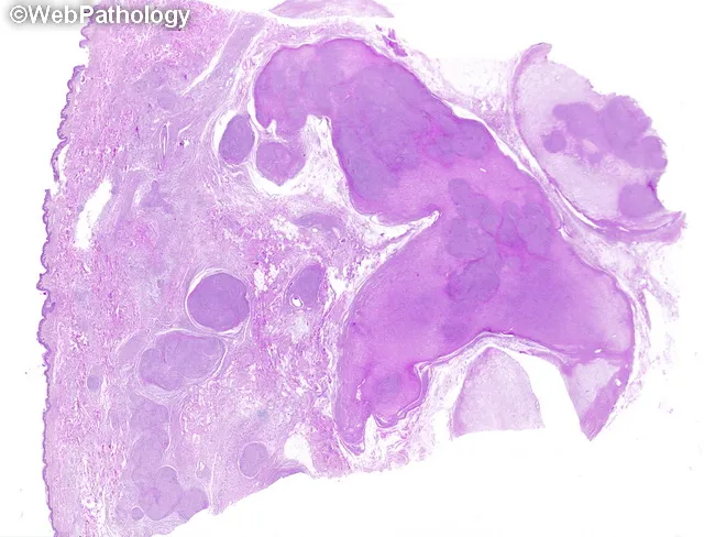 Plexiform Schwannoma