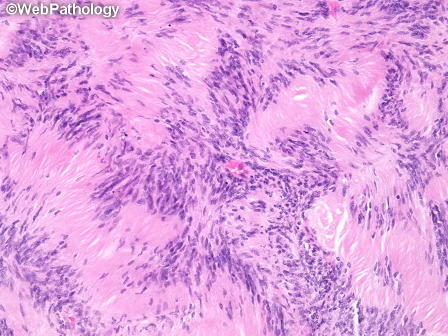 schwannoma histology findings
