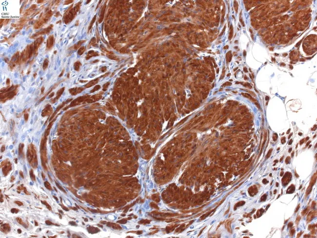 Plexiform Schwannoma : S-100