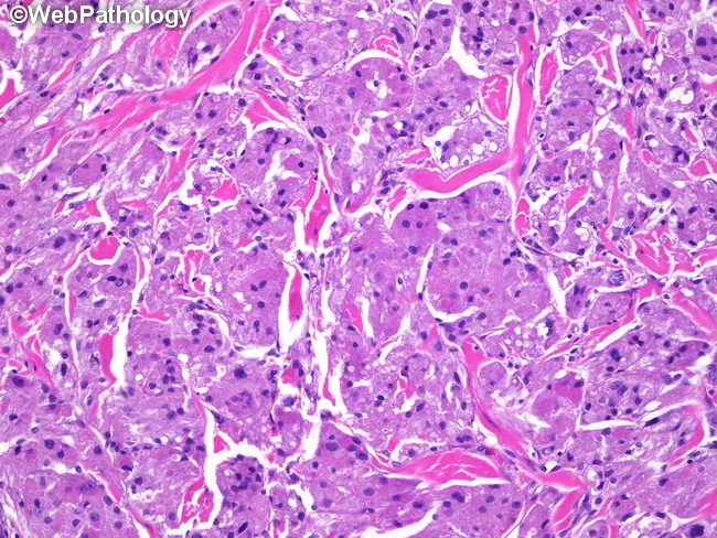Granular Cell Tumor : Microscopic