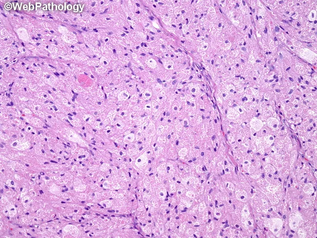 Granular Cell Tumor : Treatment