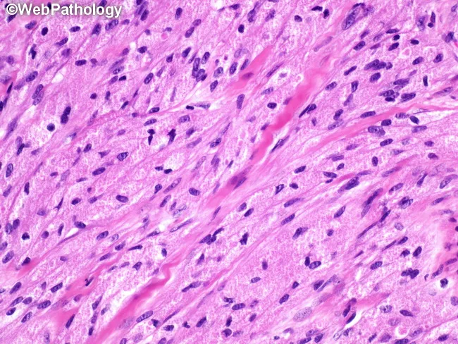 Granular Cell Tumor
