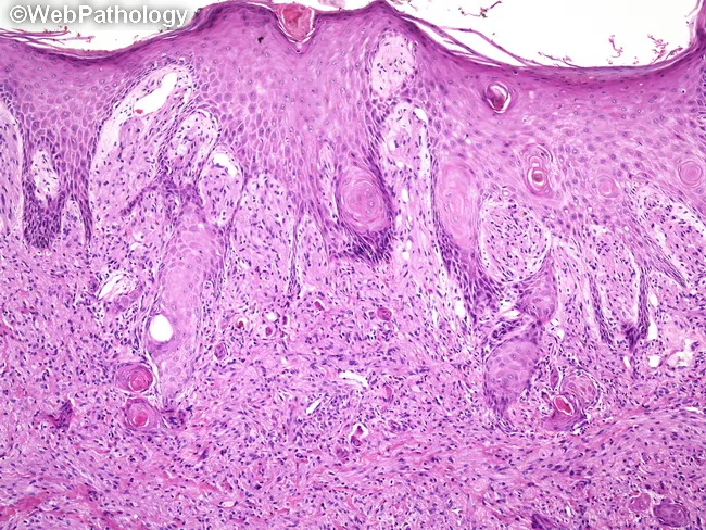 Granular Cell Tumor : Pseudoepitheliomatous Hyperplasia