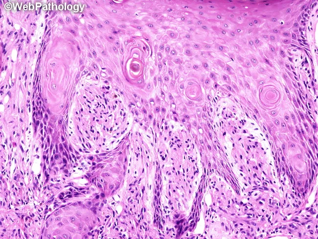 Granular Cell Tumor : Pseudoepitheliomatous Hyperplasia
