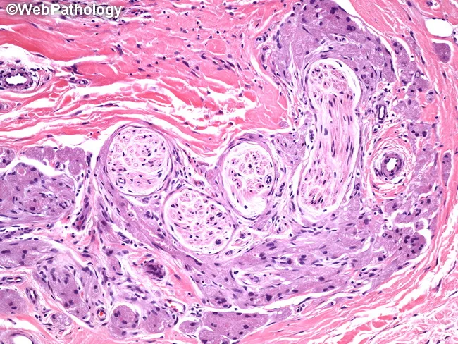 Granular Cell Tumor Infiltrative Growth