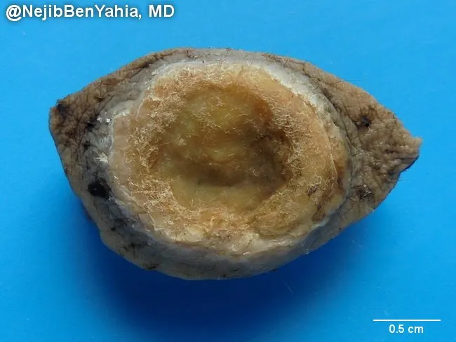 Granular Cell Tumor : Locations