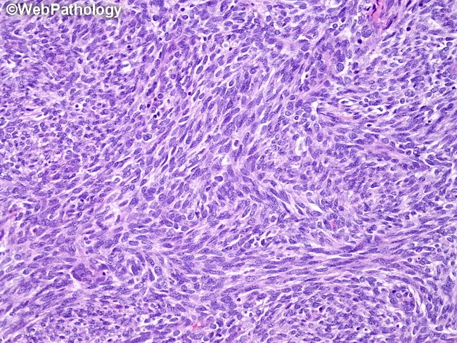 MPNST : Architecture