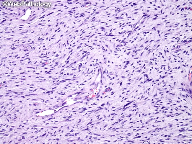 MPNST : Architecture