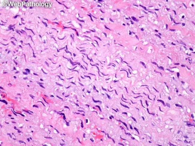MPNST : Cytologic Features