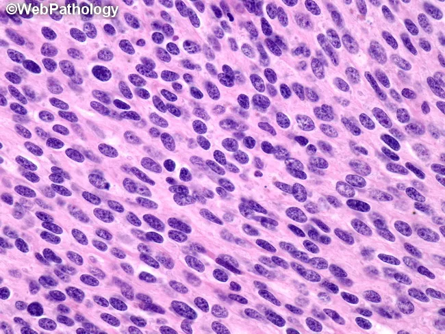 MPNST : Cytologic Features