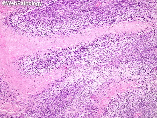 MPNST : Palisading Necrosis