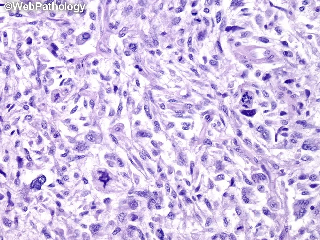 MPNST : Immunostains