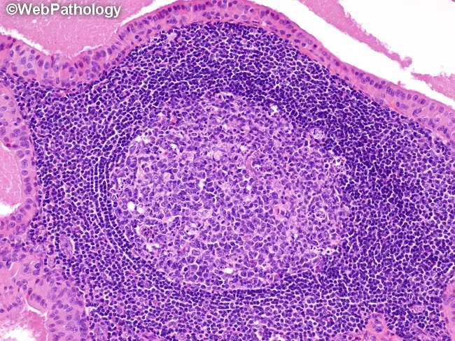 Warthin's Tumor : Pathogenesis