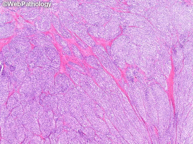 Clear Cell Sarcoma