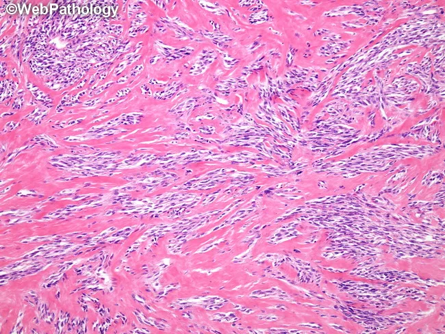 Clear Cell Sarcoma