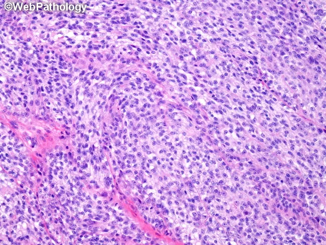 Clear Cell Sarcoma