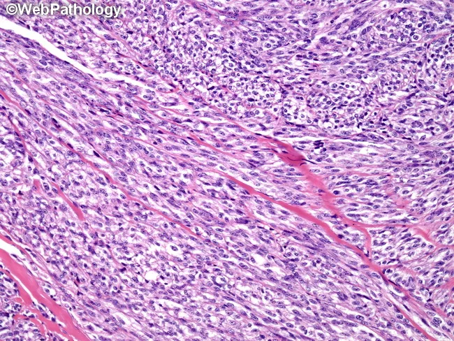 Clear Cell Sarcoma