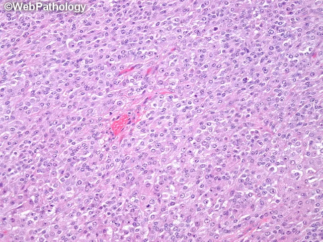 Clear Cell Sarcoma