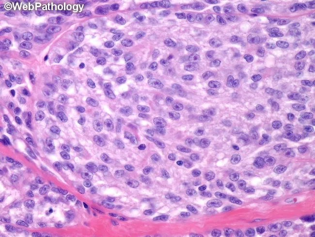 Clear Cell Sarcoma