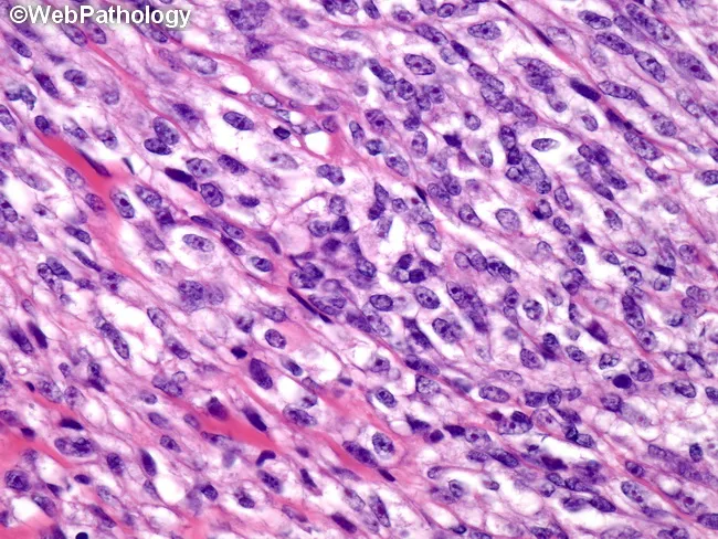 Clear Cell Sarcoma