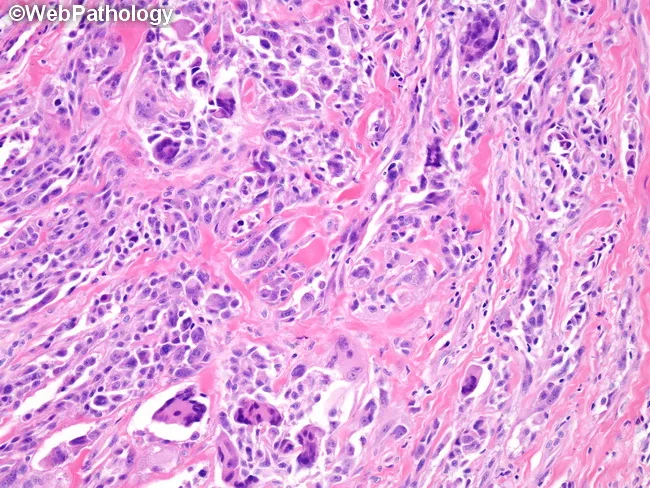 Clear Cell Sarcoma