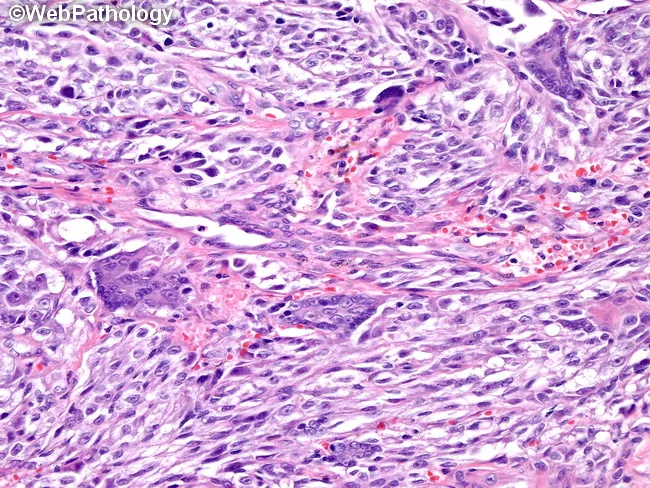 Clear Cell Sarcoma : Molecular Genetics