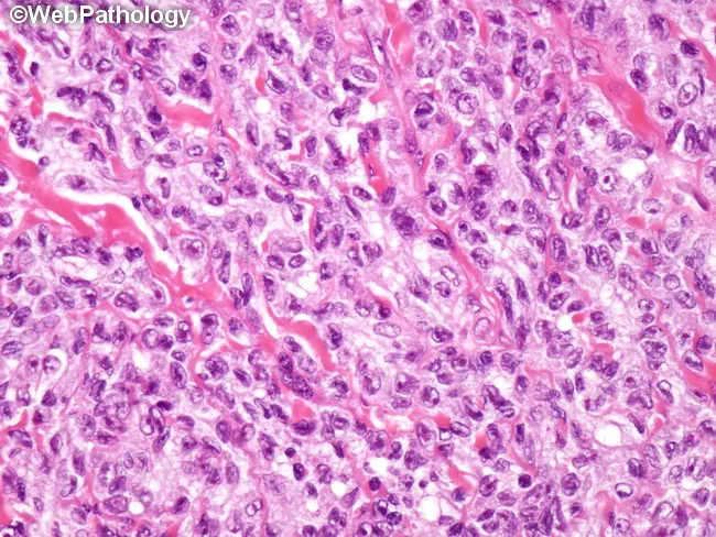 Clear Cell Sarcoma : Immunostains