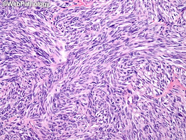 Clear Cell Sarcoma : Prognosis
