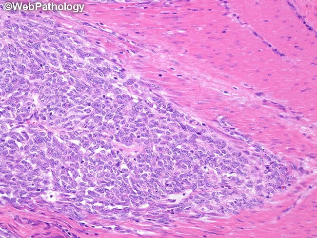 Clear Cell Sarcoma-like Tumor of GI Tract
