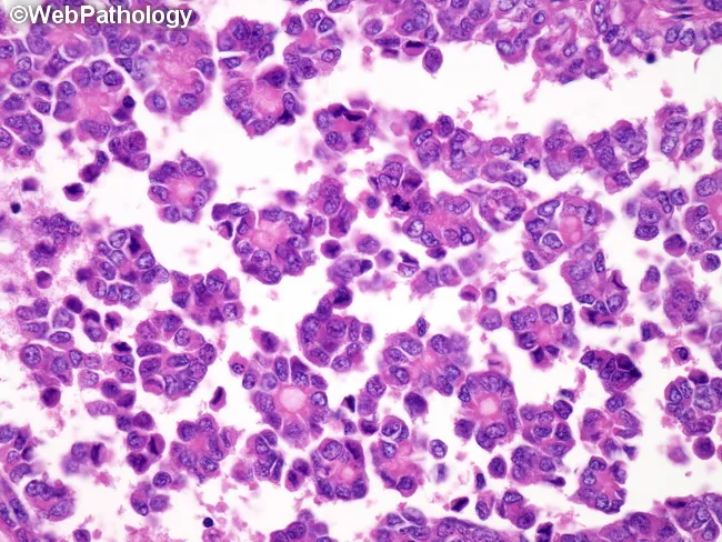 Clear Cell Sarcoma-like Tumor of GI Tract